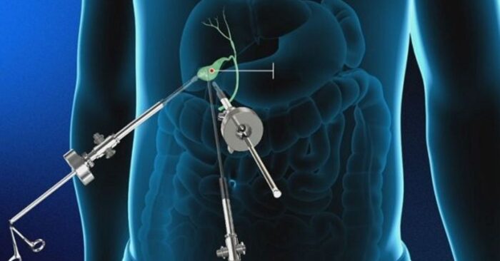 Laparotomy vs Laparoscopy: Key Surgical Differences - Capasee.com
