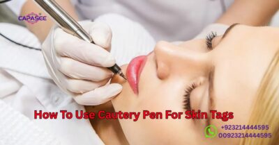 How To Use Cautery Pen For Skin Tags